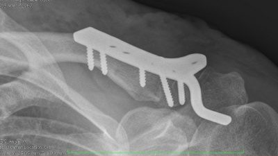 Complicaciones de fractura de clavícula - Camde - Málaga